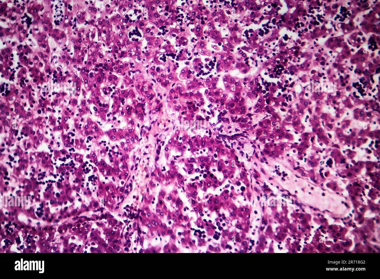 Histopathology of chronic active hepatitis, light micrograph, photo ...