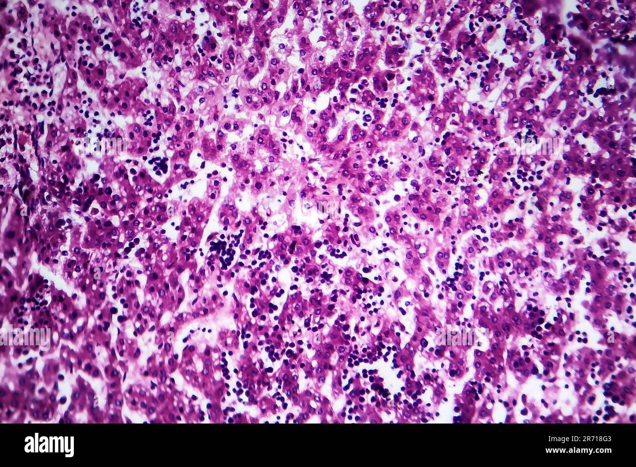 Histopathology of chronic active hepatitis, light micrograph, photo ...