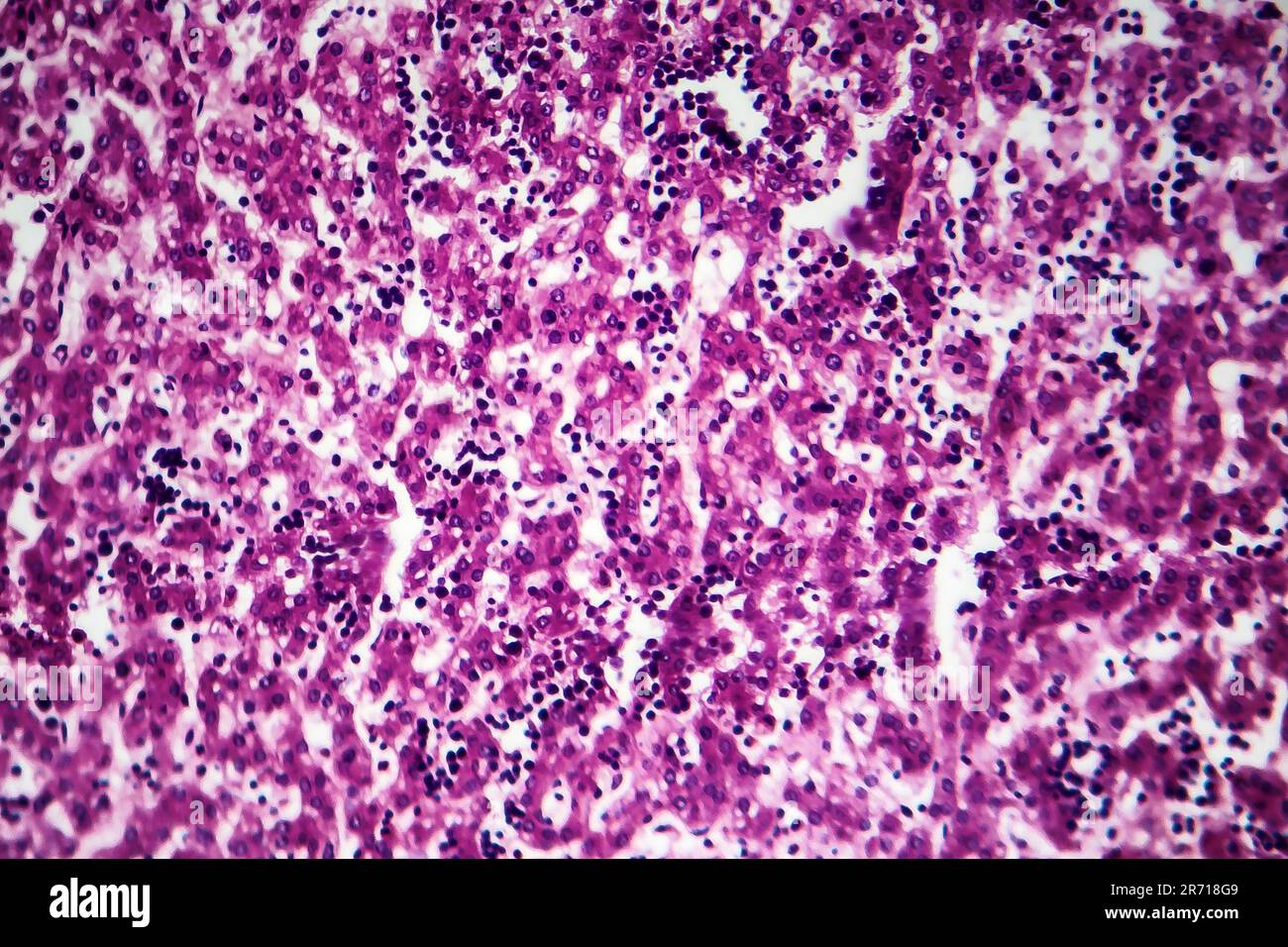 Histopathology of chronic active hepatitis, light micrograph, photo ...