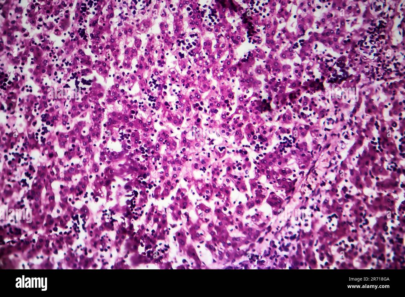 Histopathology of chronic active hepatitis, light micrograph, photo ...