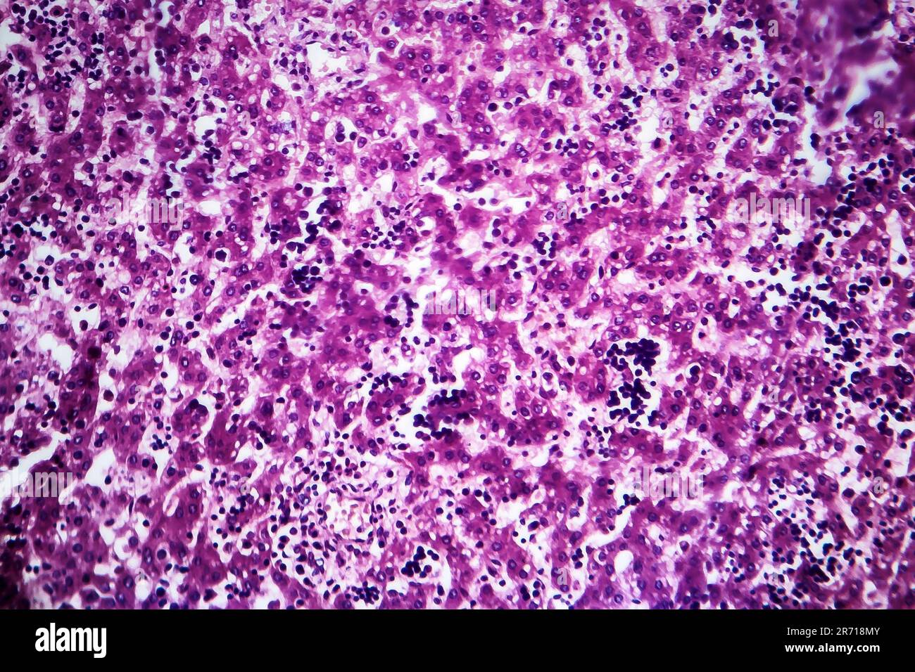 Histopathology of chronic active hepatitis, light micrograph, photo ...