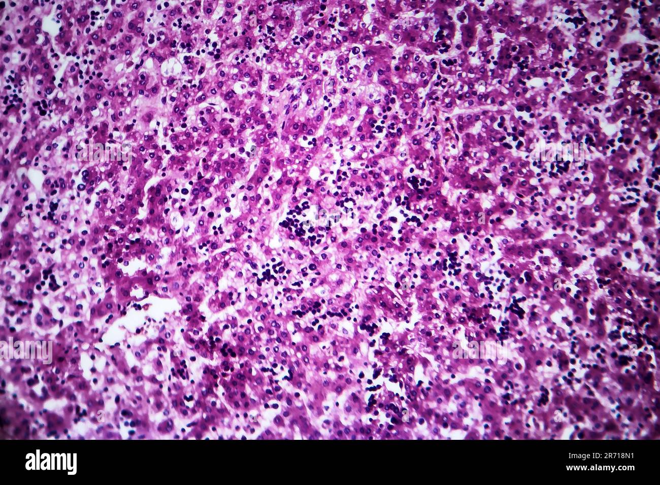 Histopathology of chronic active hepatitis, light micrograph, photo ...