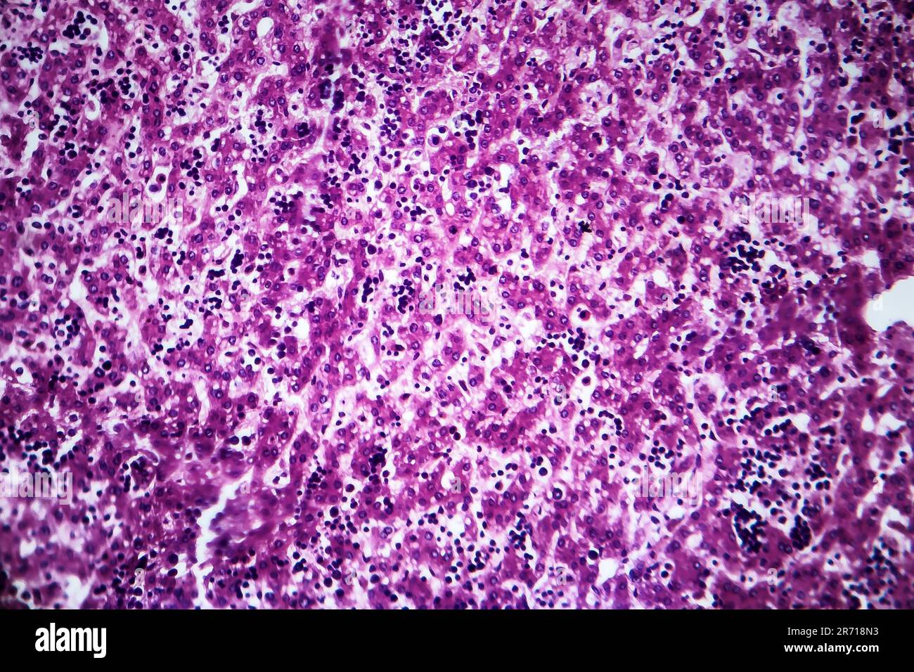Histopathology of chronic active hepatitis, light micrograph, photo ...