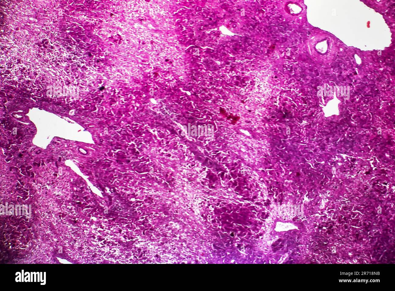Histopathology of subacute severe hepatitis, light micrograph, photo ...
