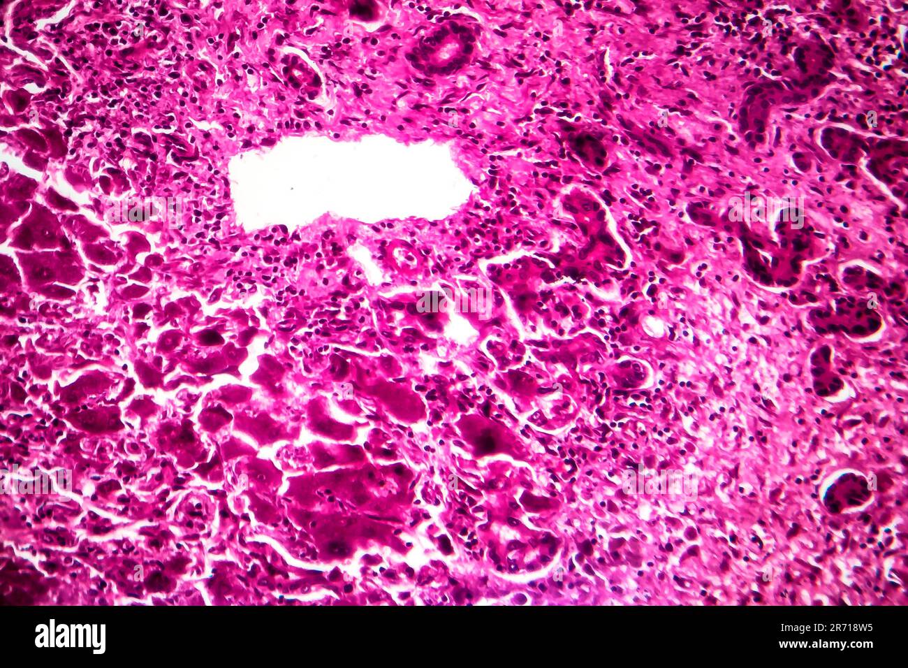 Histopathology of subacute severe hepatitis, light micrograph, photo ...