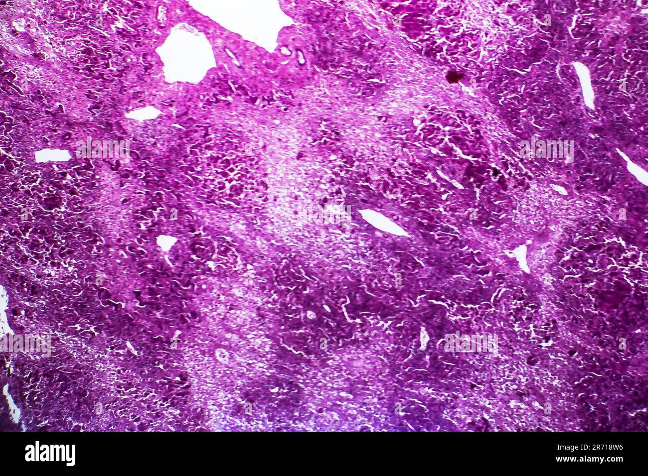 Histopathology of subacute severe hepatitis, light micrograph, photo ...