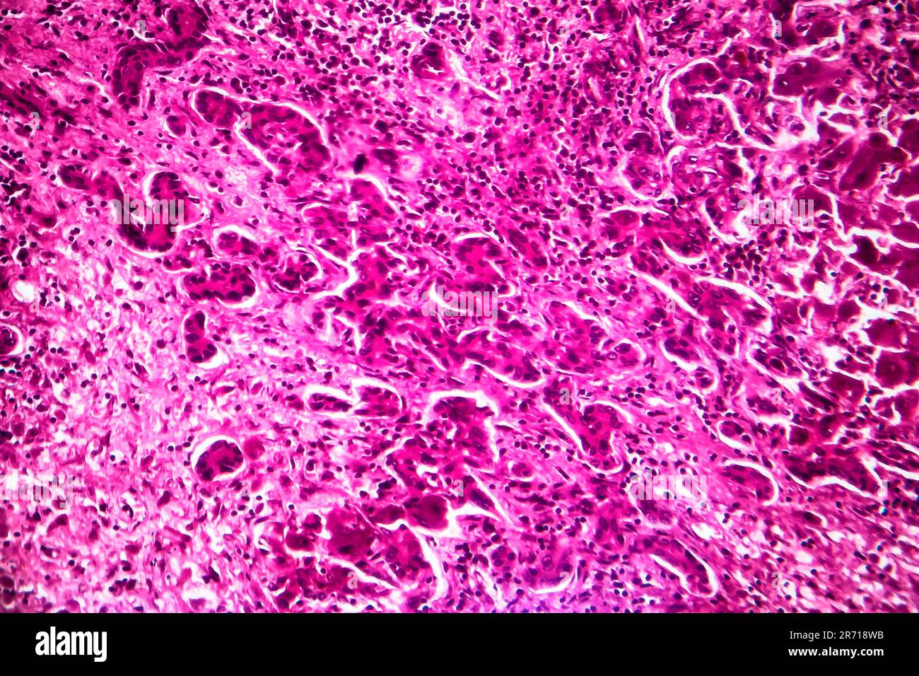 Histopathology of subacute severe hepatitis, light micrograph, photo ...