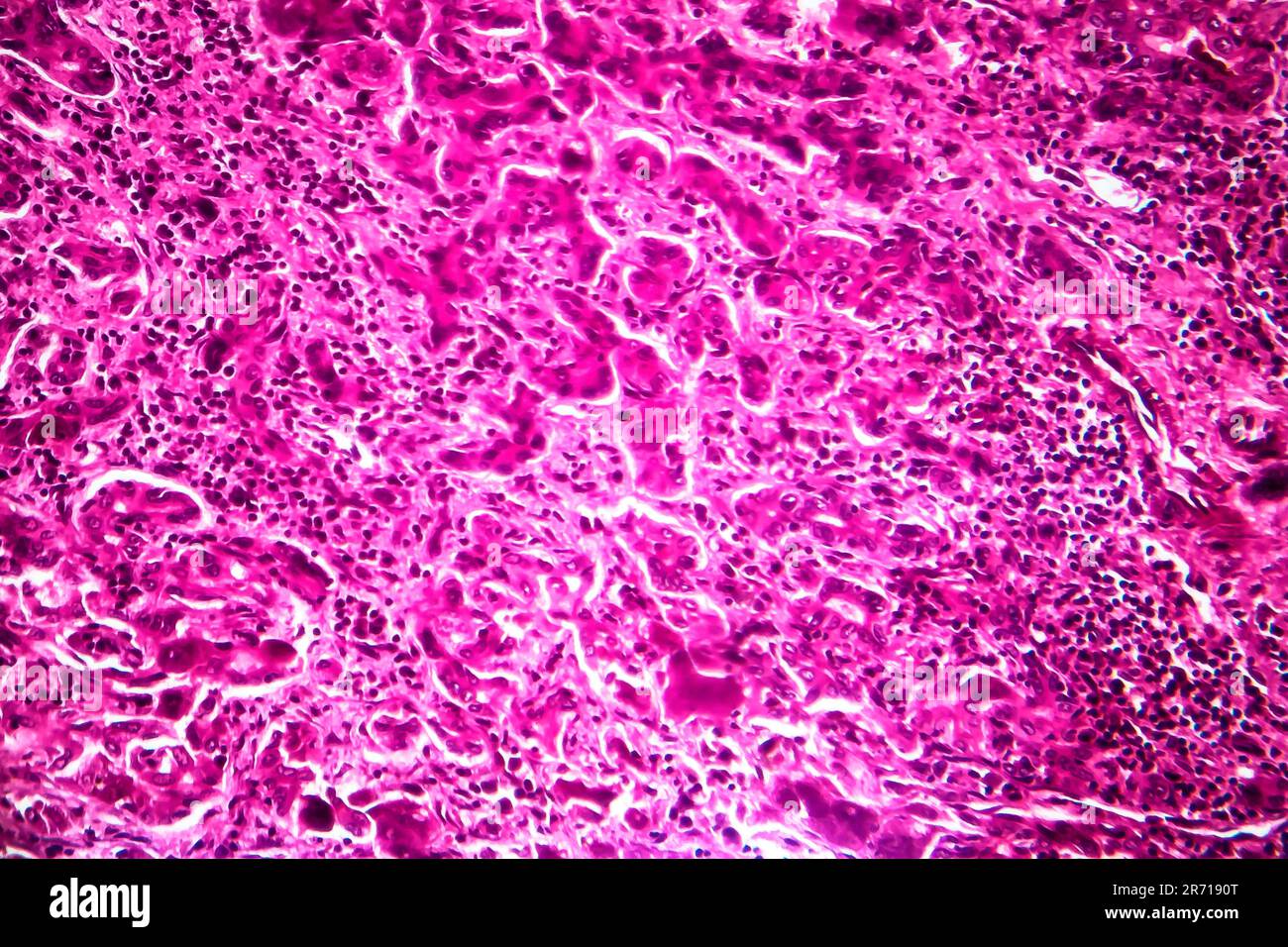 Histopathology of subacute severe hepatitis, light micrograph, photo ...
