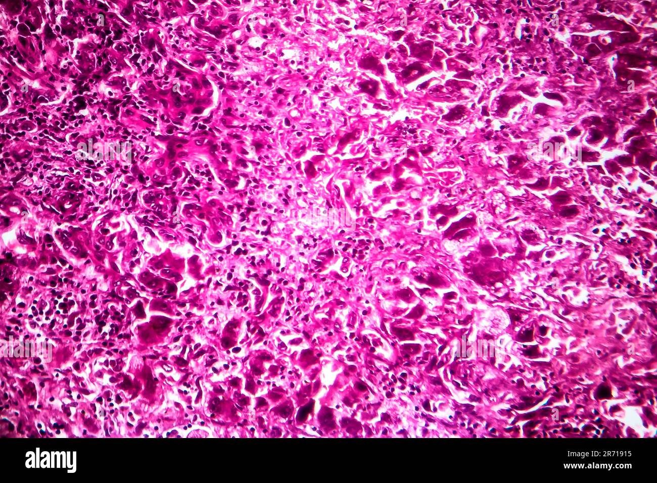 Histopathology of subacute severe hepatitis, light micrograph, photo ...