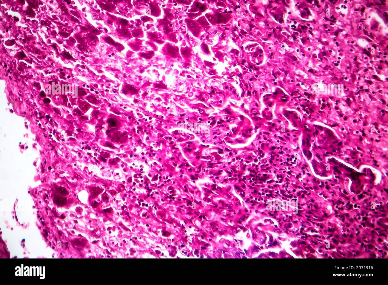 Histopathology of subacute severe hepatitis, light micrograph, photo ...