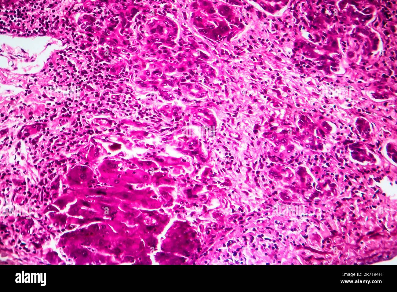 Histopathology of subacute severe hepatitis, light micrograph, photo ...