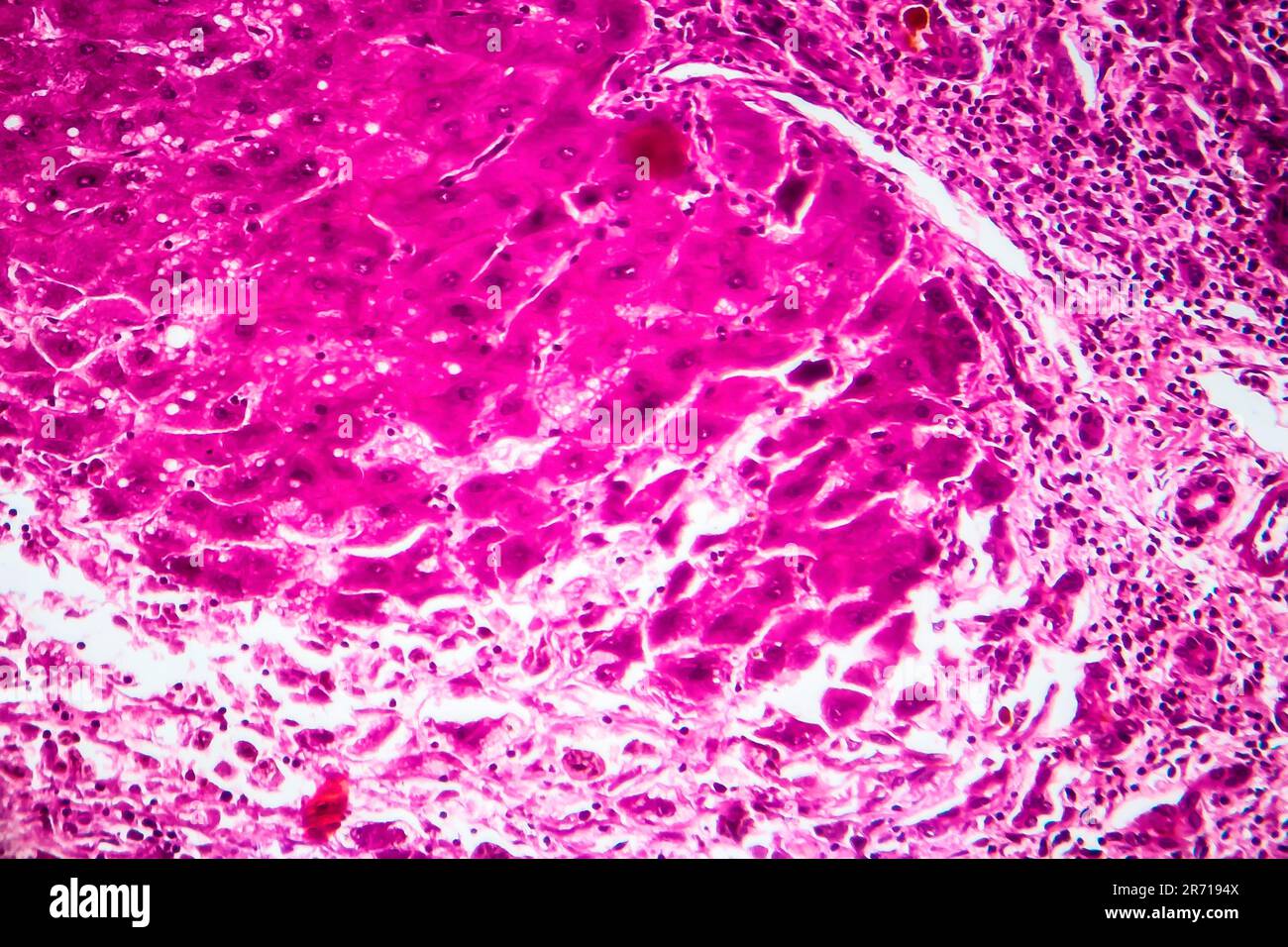 Histopathology of subacute severe hepatitis, light micrograph, photo ...