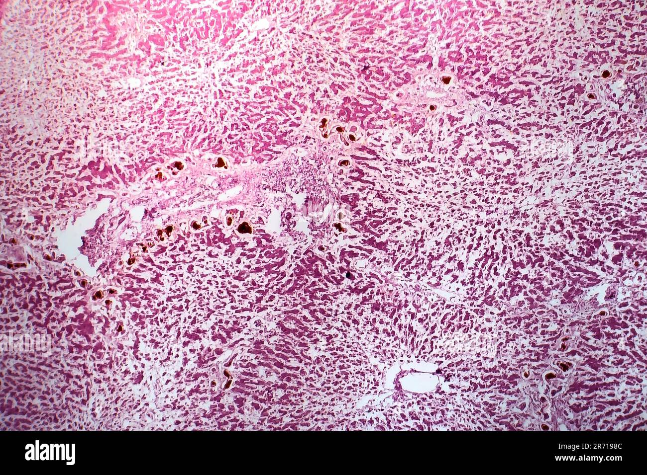 Histopathology of acute severe hepatitis, light micrograph, photo under ... Histopathology of acute severe hepatitis, light micrograph, photo under ...