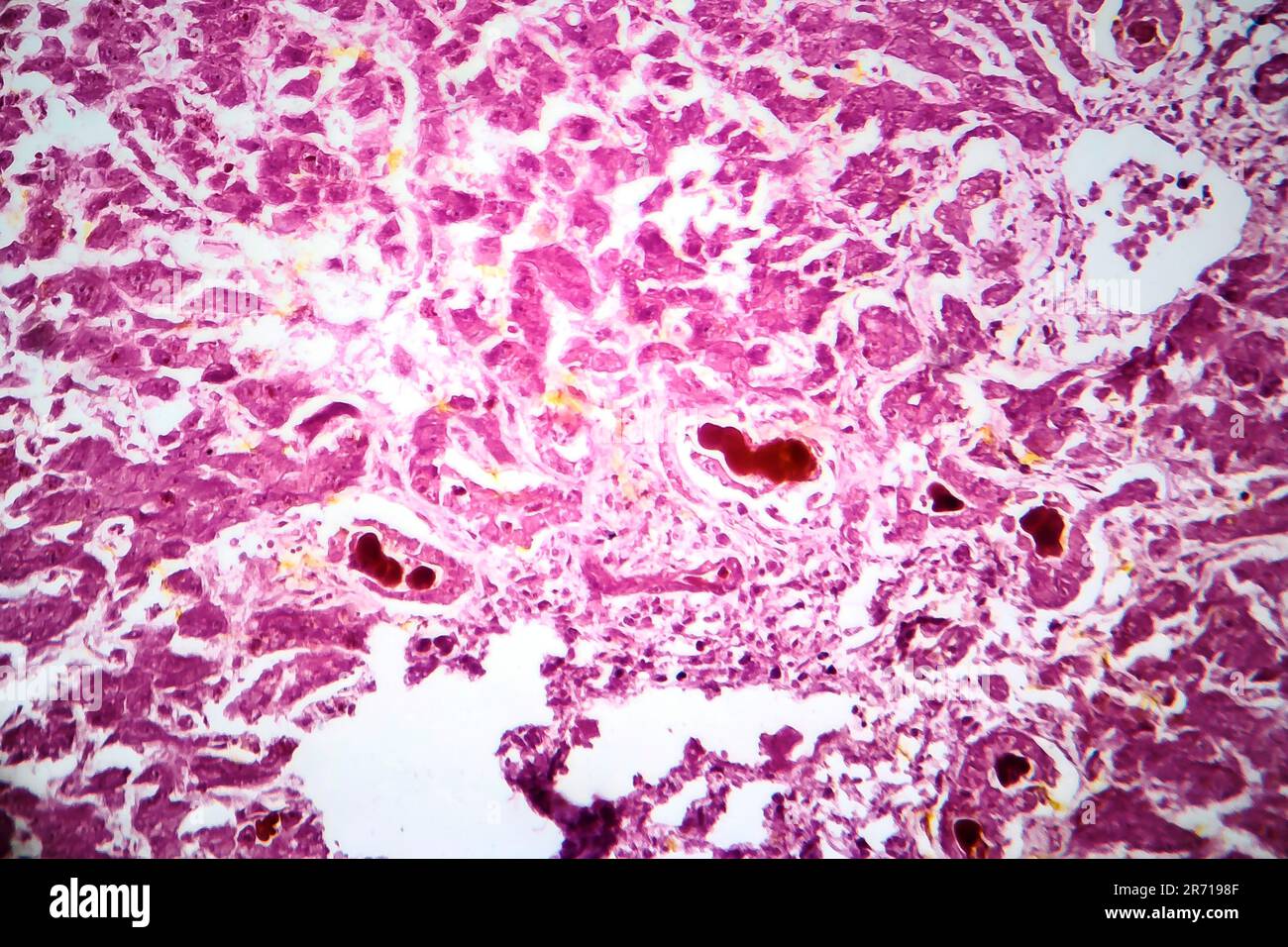 Histopathology of acute severe hepatitis, light micrograph, photo under ... Histopathology of acute severe hepatitis, light micrograph, photo under ...