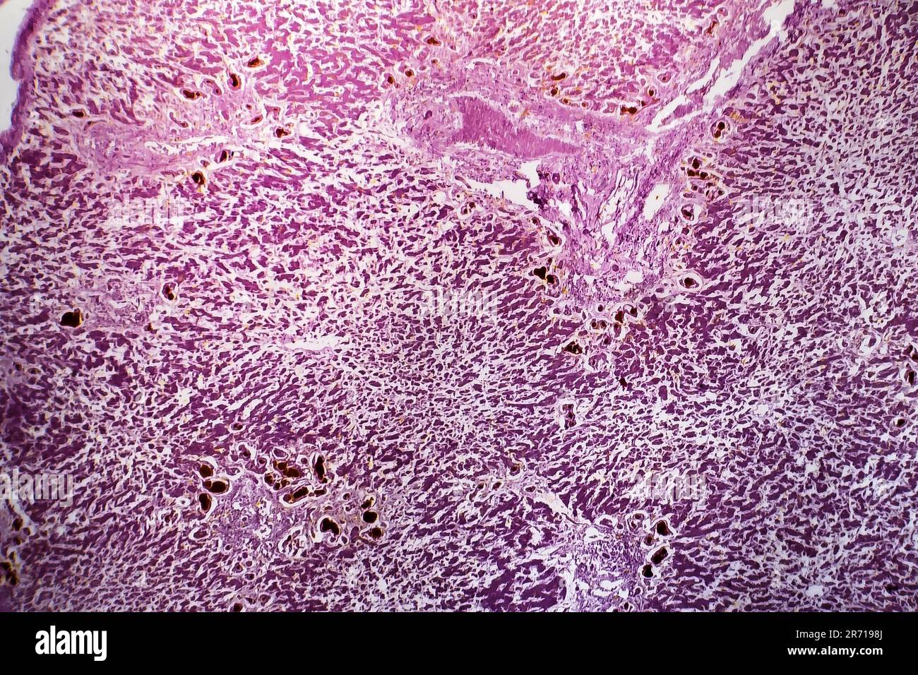 Histopathology of acute severe hepatitis, light micrograph, photo under ... Histopathology of acute severe hepatitis, light micrograph, photo under ...
