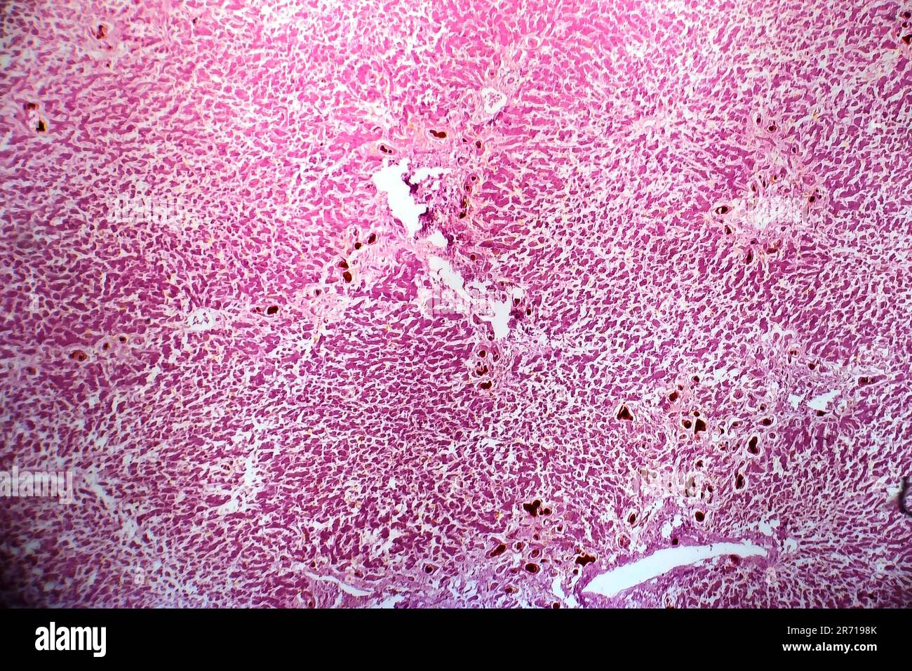 Histopathology of acute severe hepatitis, light micrograph, photo under ...