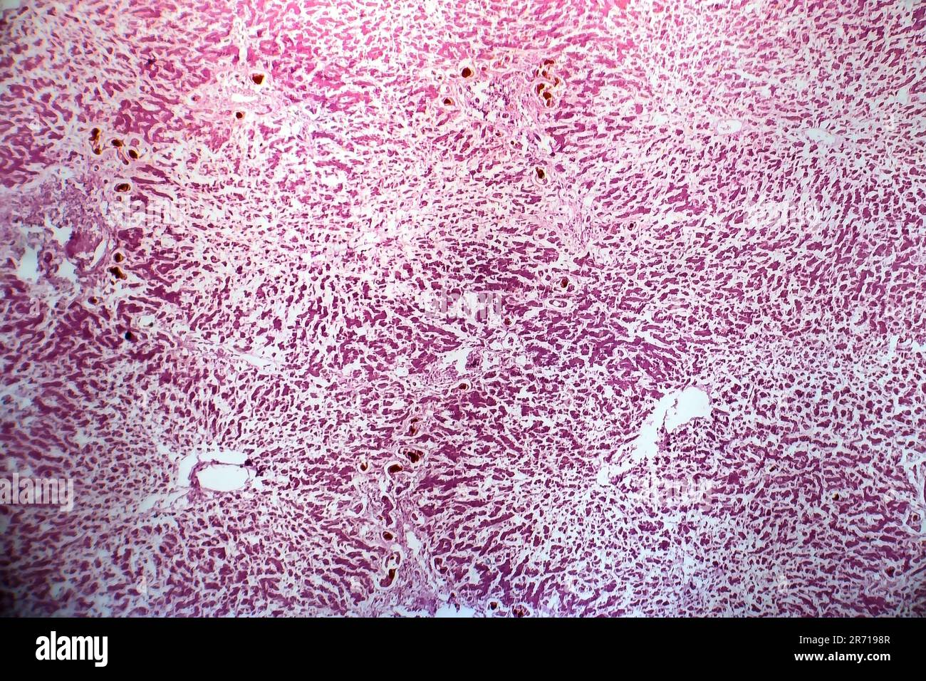 Histopathology of acute severe hepatitis, light micrograph, photo under ...