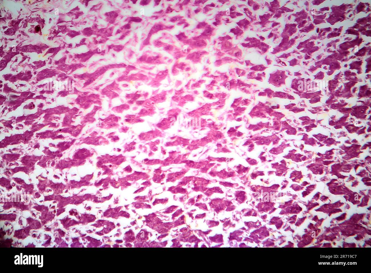Histopathology of acute severe hepatitis, light micrograph, photo under ...