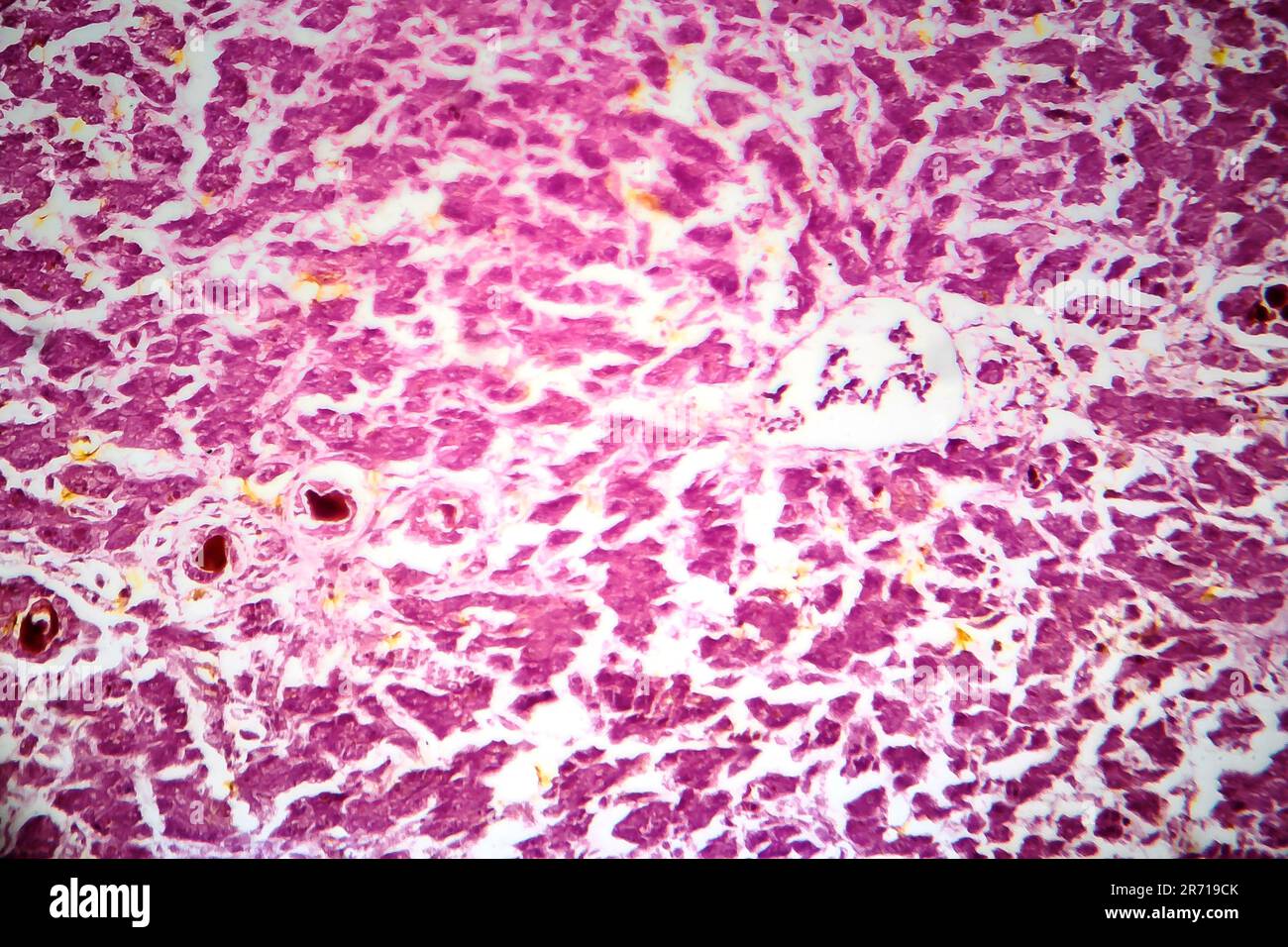 Histopathology of acute severe hepatitis, light micrograph, photo under ... Histopathology of acute severe hepatitis, light micrograph, photo under ...