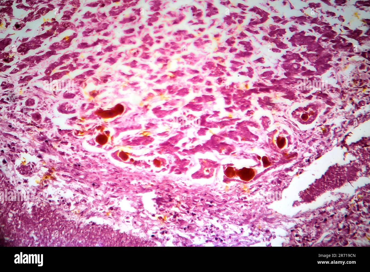 Histopathology of acute severe hepatitis, light micrograph, photo under ... Histopathology of acute severe hepatitis, light micrograph, photo under ...