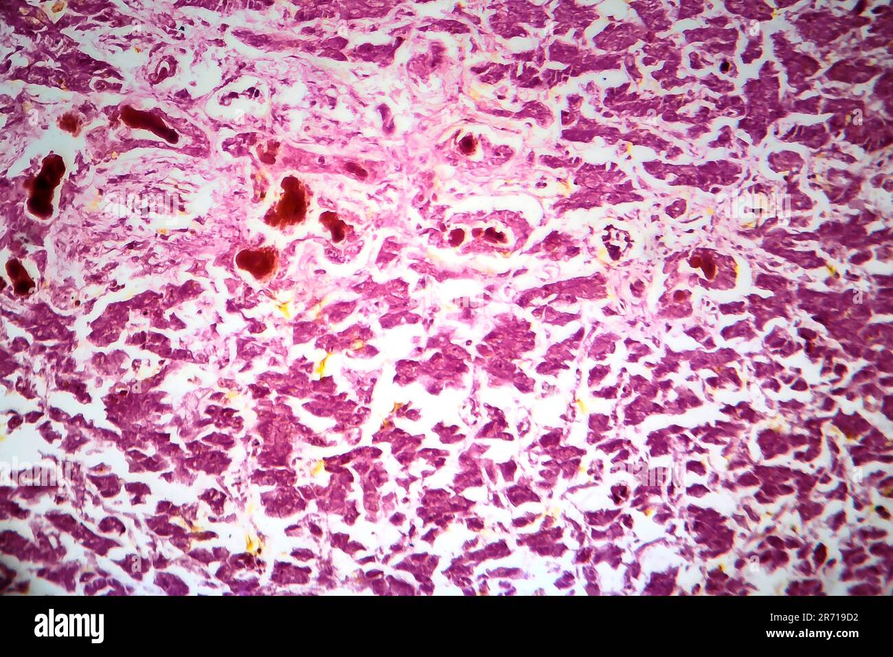 Histopathology of acute severe hepatitis, light micrograph, photo under ...