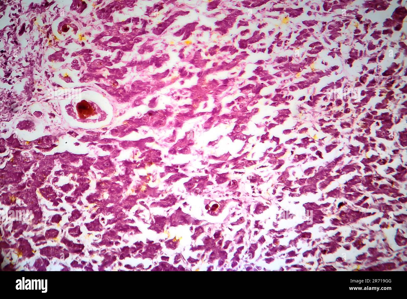 Histopathology of acute severe hepatitis, light micrograph, photo under ...