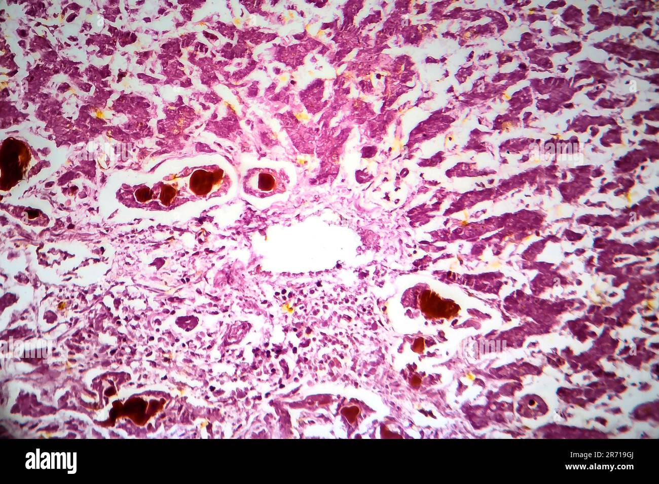 Histopathology of acute severe hepatitis, light micrograph, photo under ...