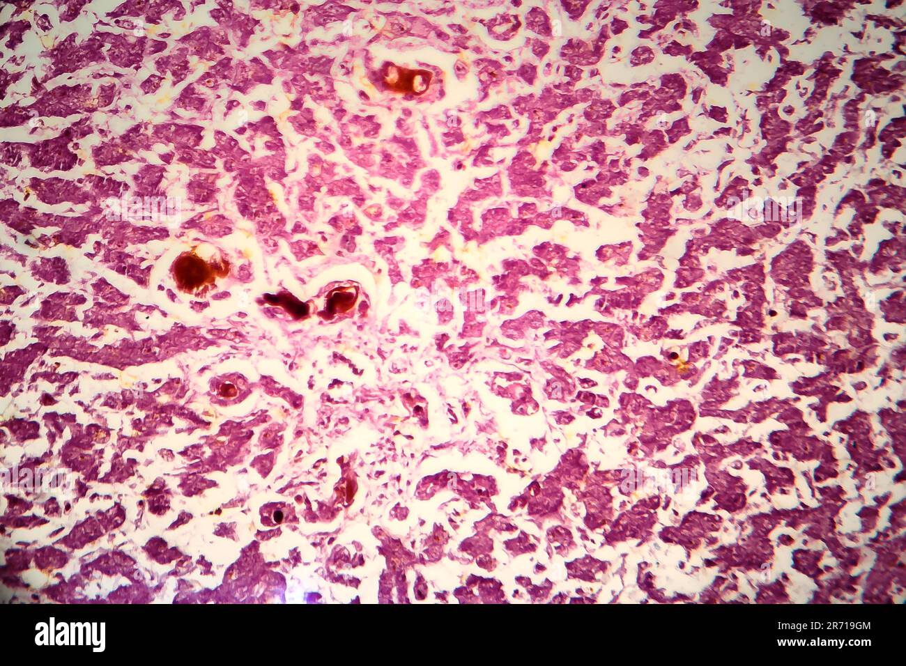 Histopathology of acute severe hepatitis, light micrograph, photo under ...
