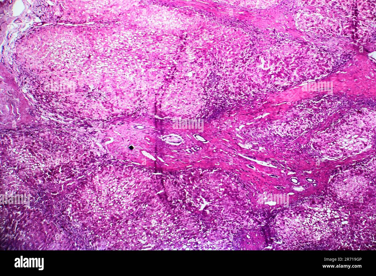Histopathology of alcoholic hepatitis, light micrograph, photo under ...