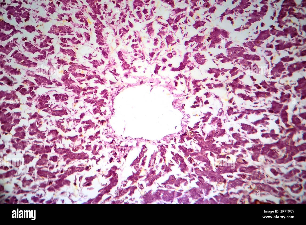 Histopathology of acute severe hepatitis, light micrograph, photo under ...