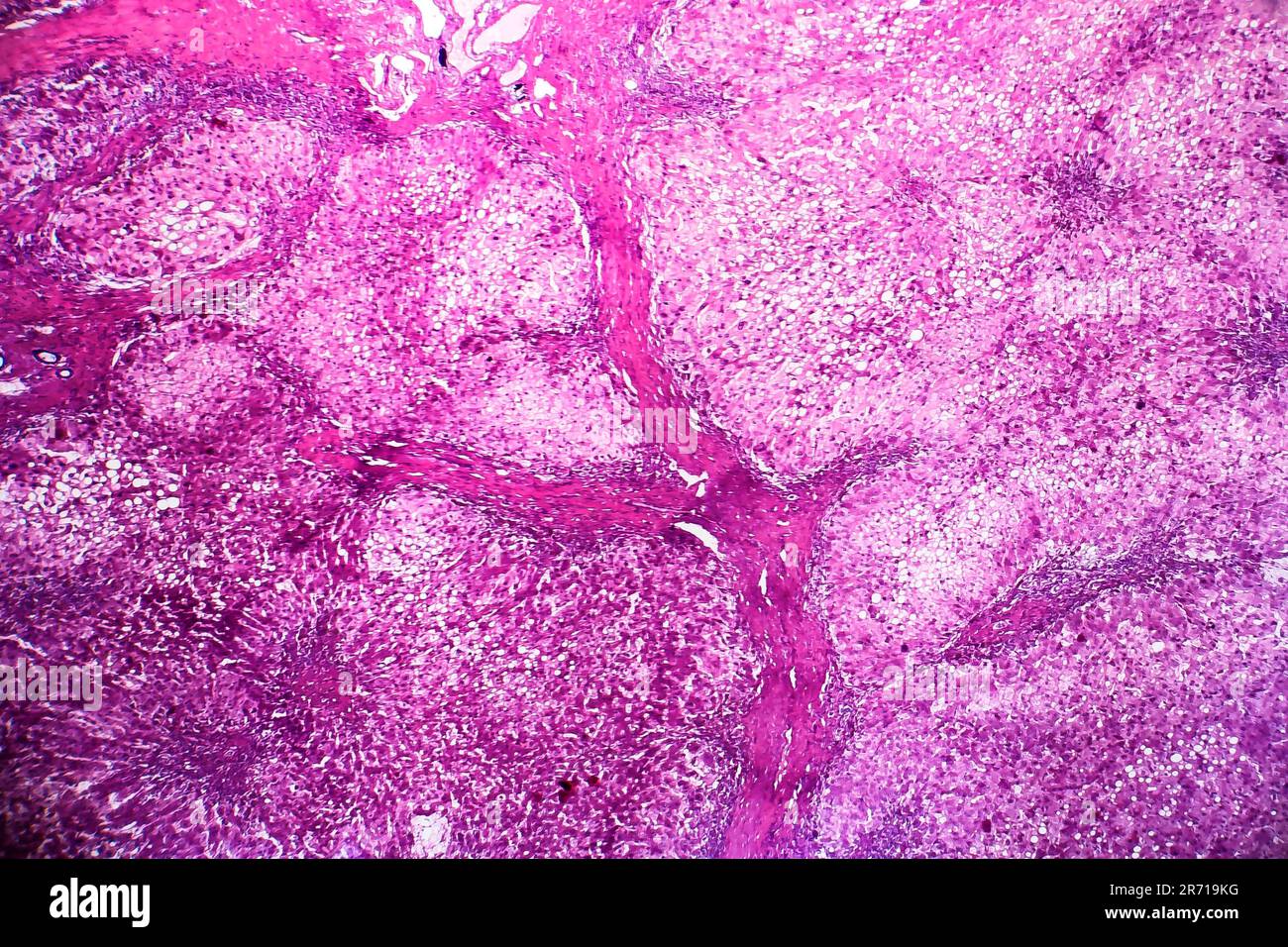 Histopathology of alcoholic hepatitis, light micrograph, photo under ...