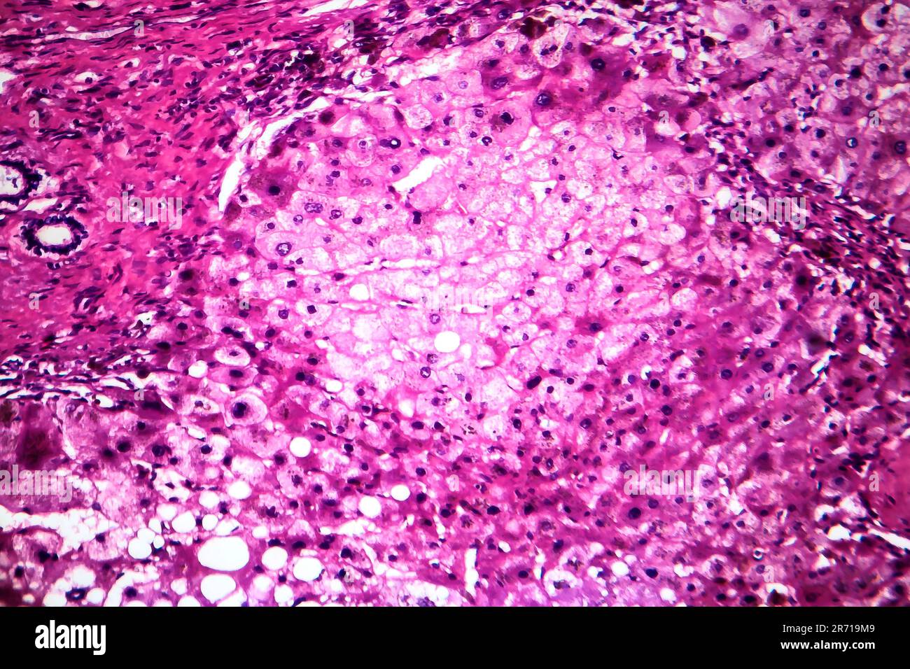 Histopathology of alcoholic hepatitis, light micrograph, photo under ...
