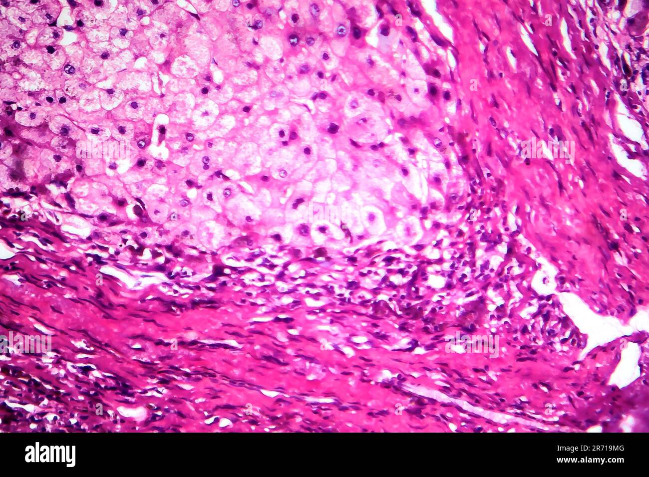 Histopathology of alcoholic hepatitis, light micrograph, photo under ...