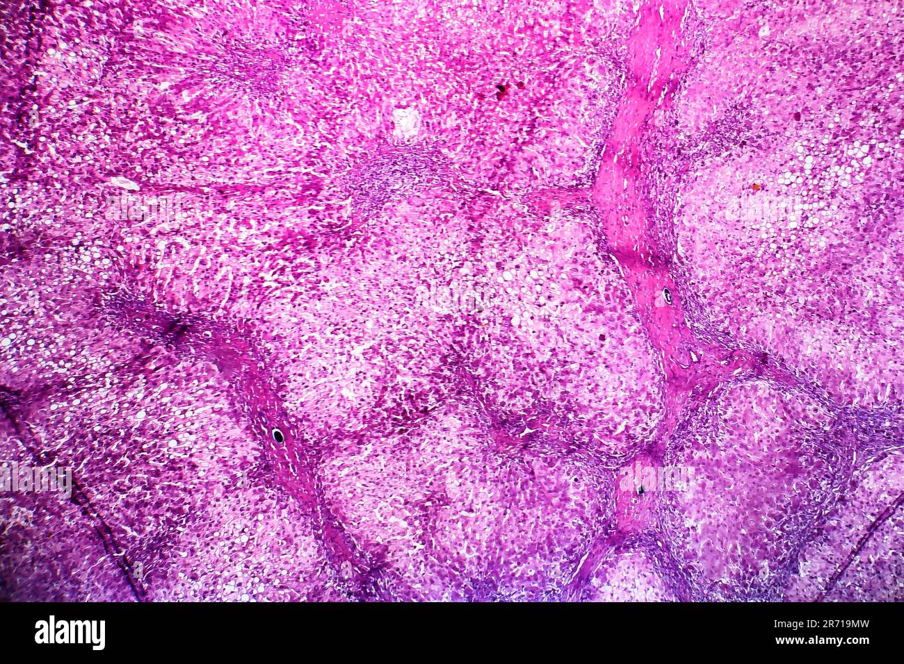 Histopathology of alcoholic hepatitis, light micrograph, photo under ...