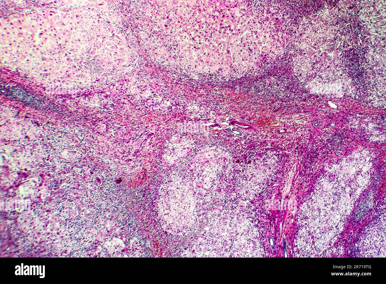 Histopathology of portal liver cirrhosis, light micrograph, photo under ...