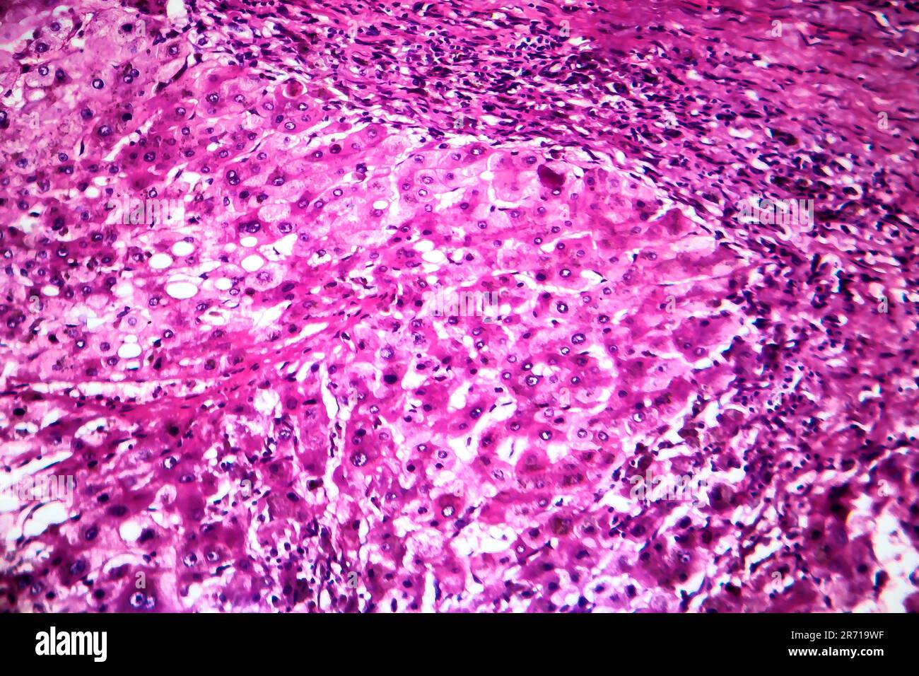 Histopathology of alcoholic hepatitis, light micrograph, photo under ...