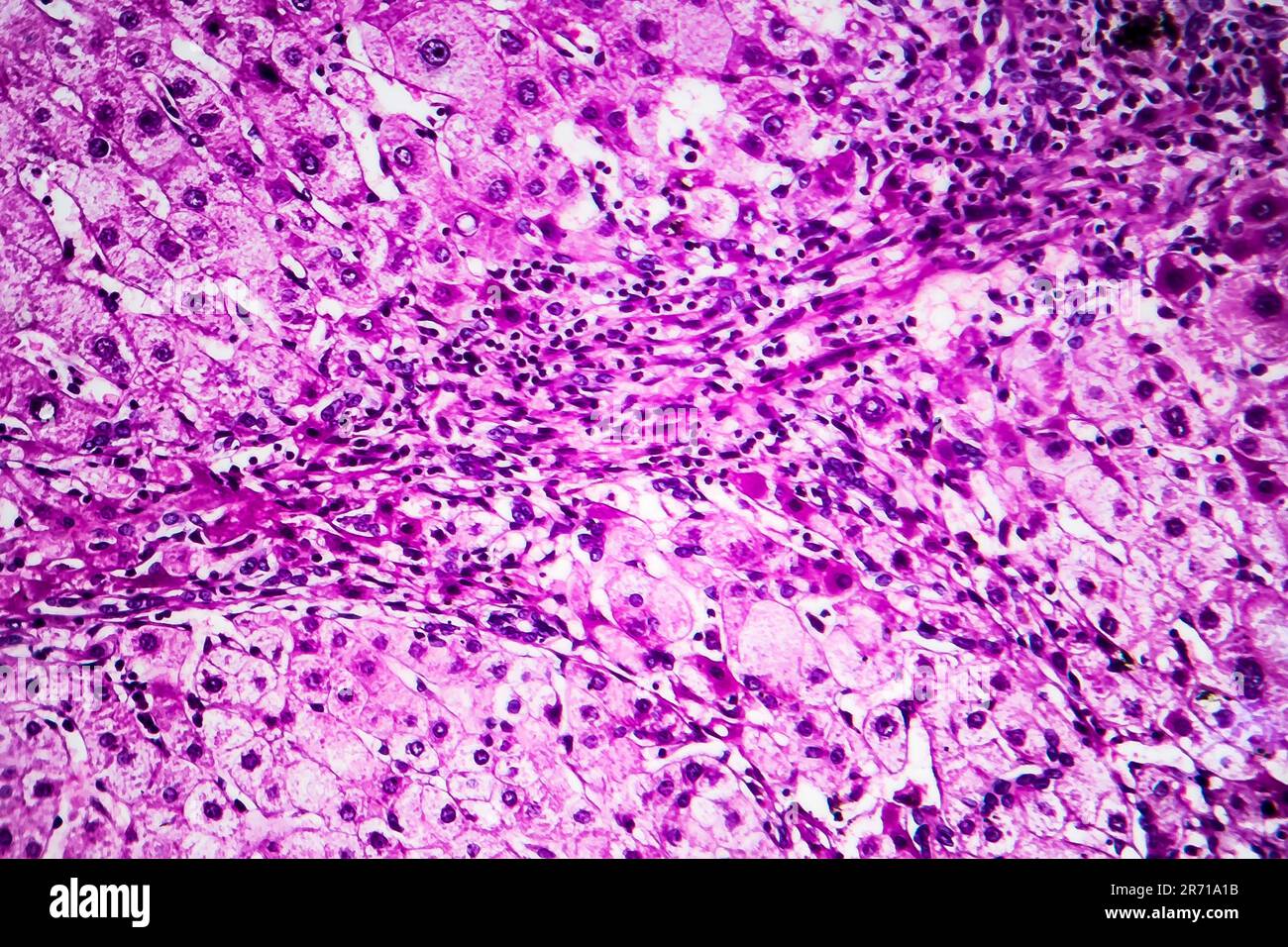 Histopathology of portal liver cirrhosis, light micrograph, photo under ...