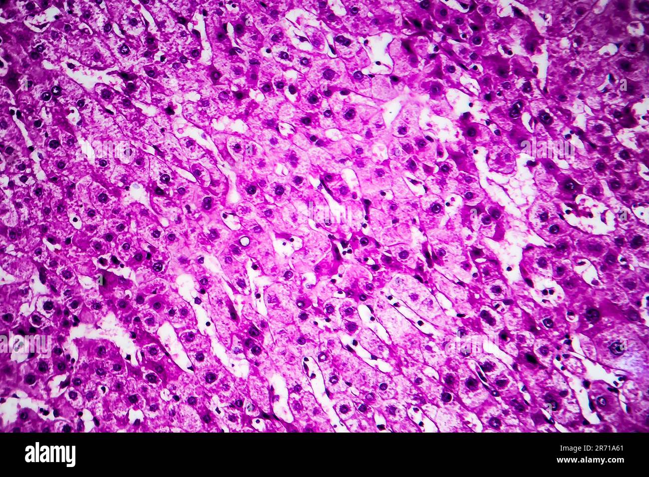 Histopathology of portal liver cirrhosis, light micrograph, photo under ...