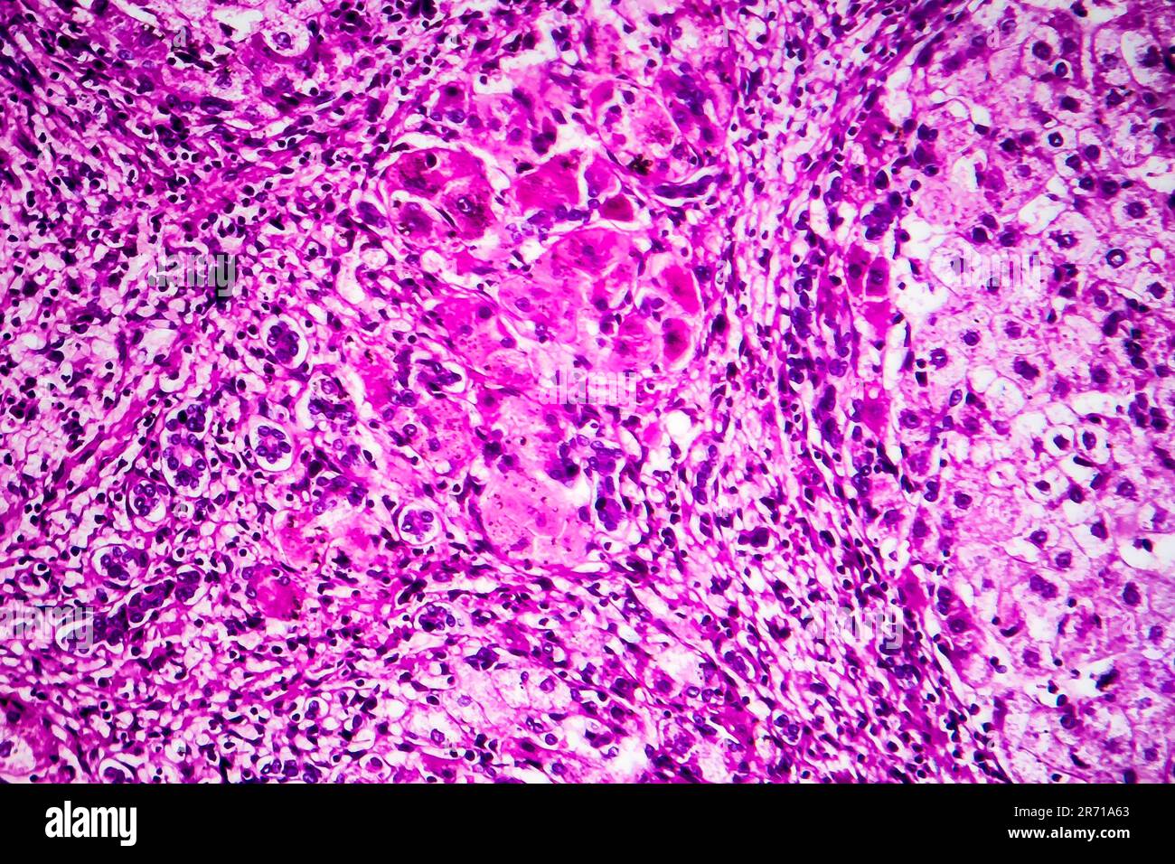 Histopathology of portal liver cirrhosis, light micrograph, photo under ...