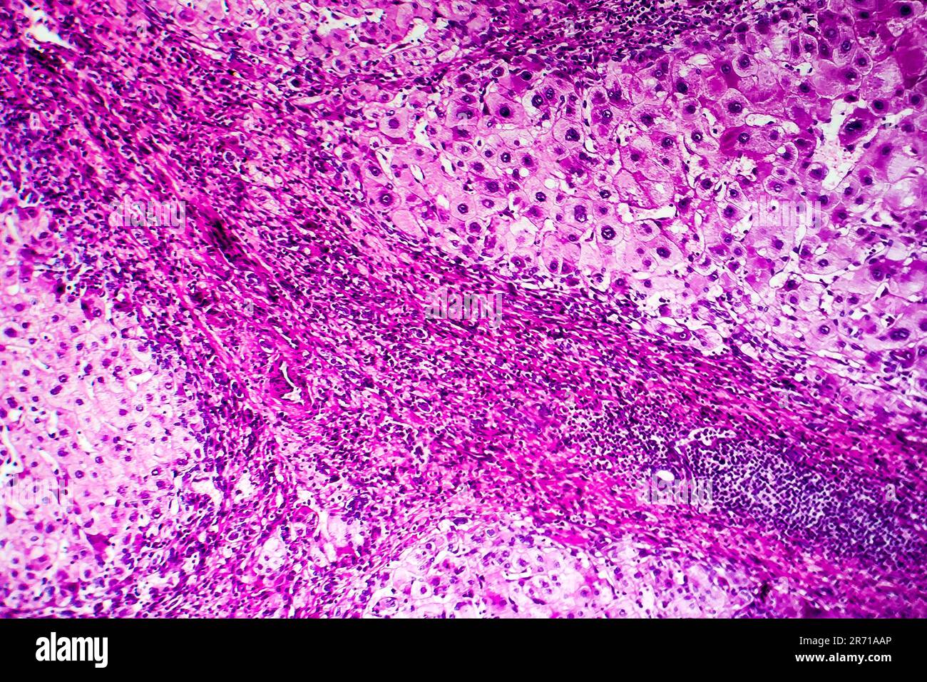 Histopathology of portal liver cirrhosis, light micrograph, photo under ...