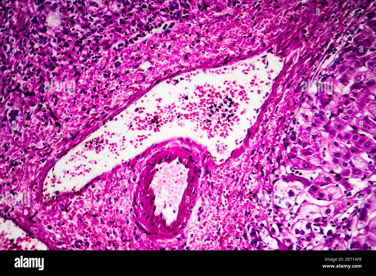 Histopathology of portal liver cirrhosis, light micrograph, photo under ...
