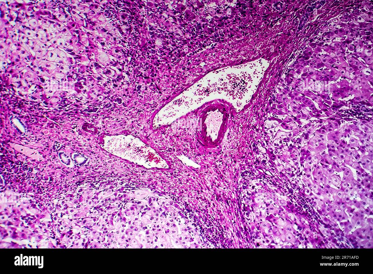 Histopathology of portal liver cirrhosis, light micrograph, photo under ...