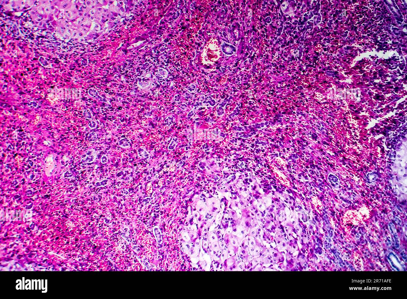 Histopathology of portal liver cirrhosis, light micrograph, photo under ...