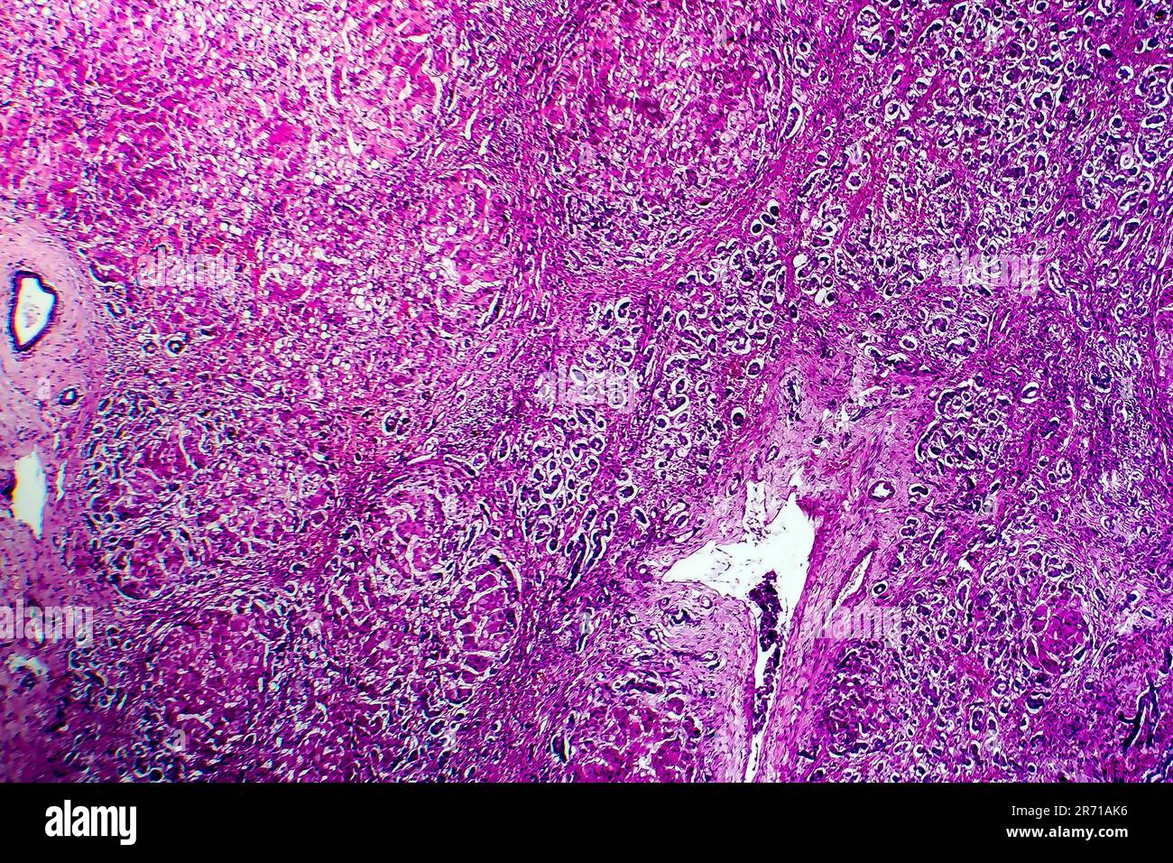 Histopathology of biliary liver cirrhosis, light micrograph, photo ...
