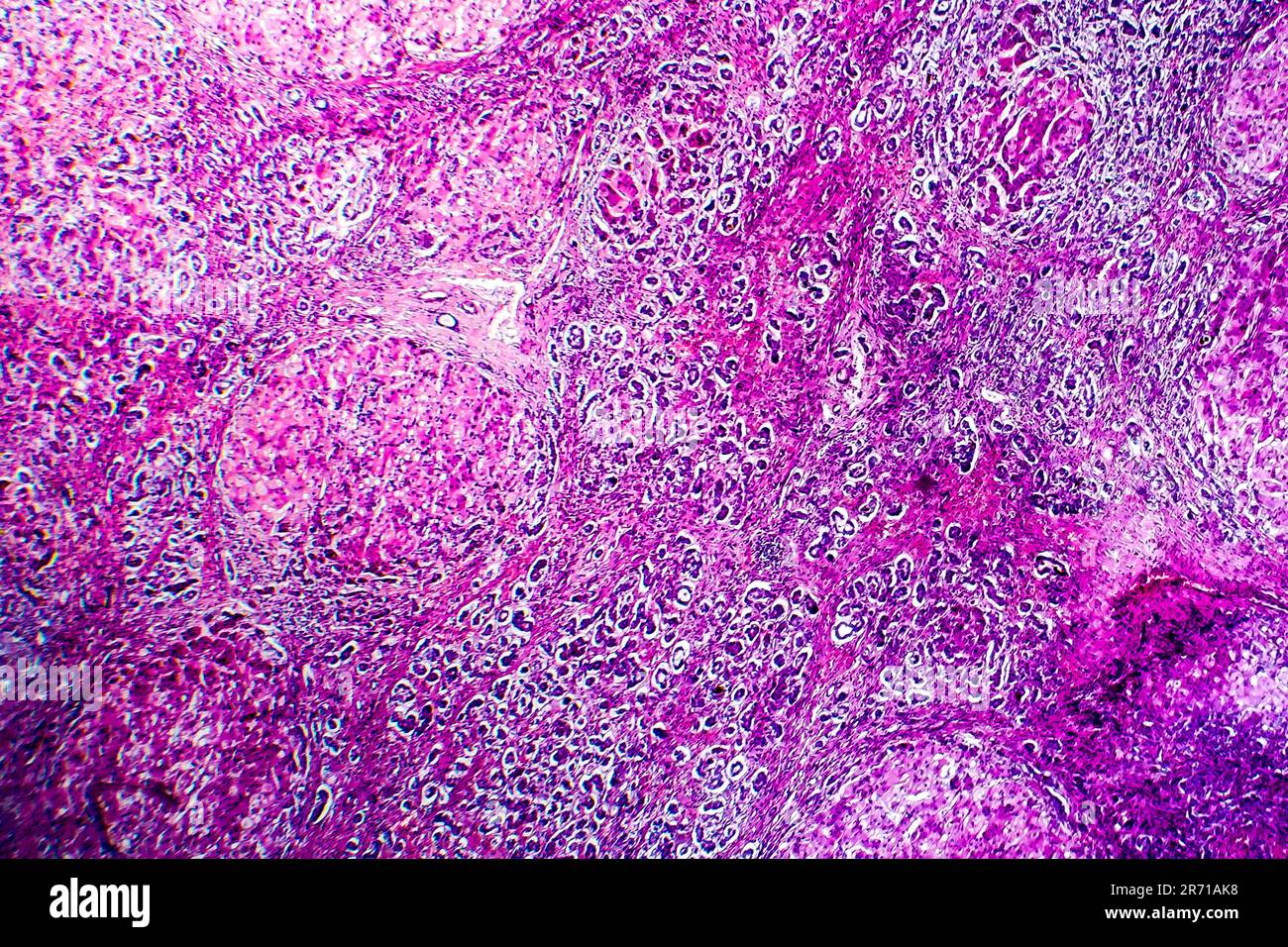 Histopathology of biliary liver cirrhosis, light micrograph, photo ...