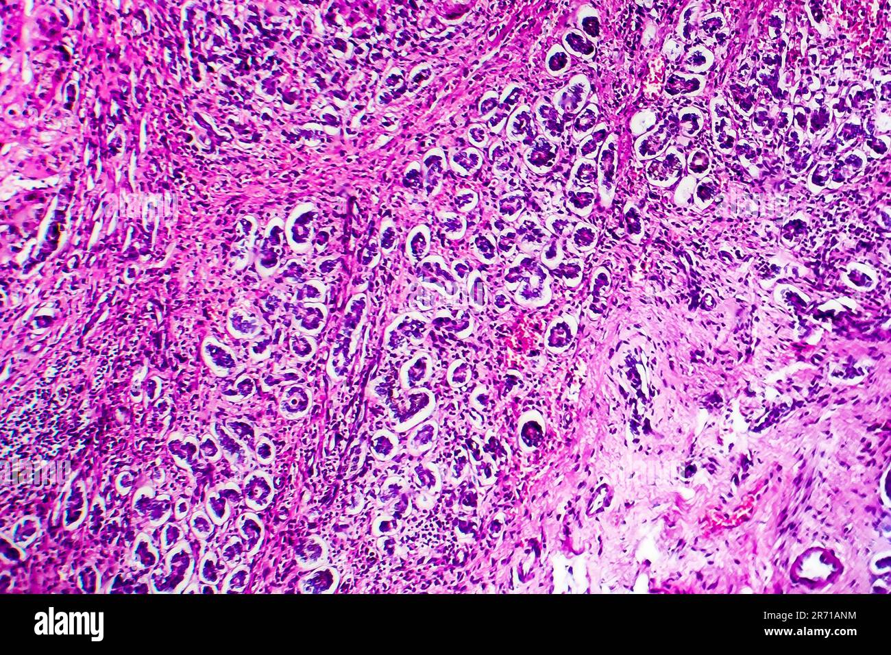 Histopathology of biliary liver cirrhosis, light micrograph, photo ...