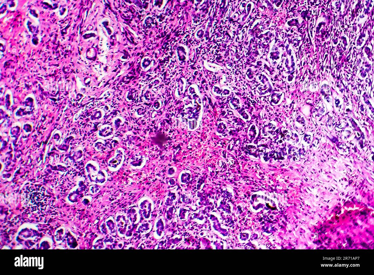 Histopathology of biliary liver cirrhosis, light micrograph, photo ...