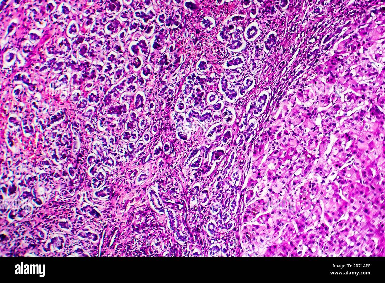 Histopathology of biliary liver cirrhosis, light micrograph, photo ...