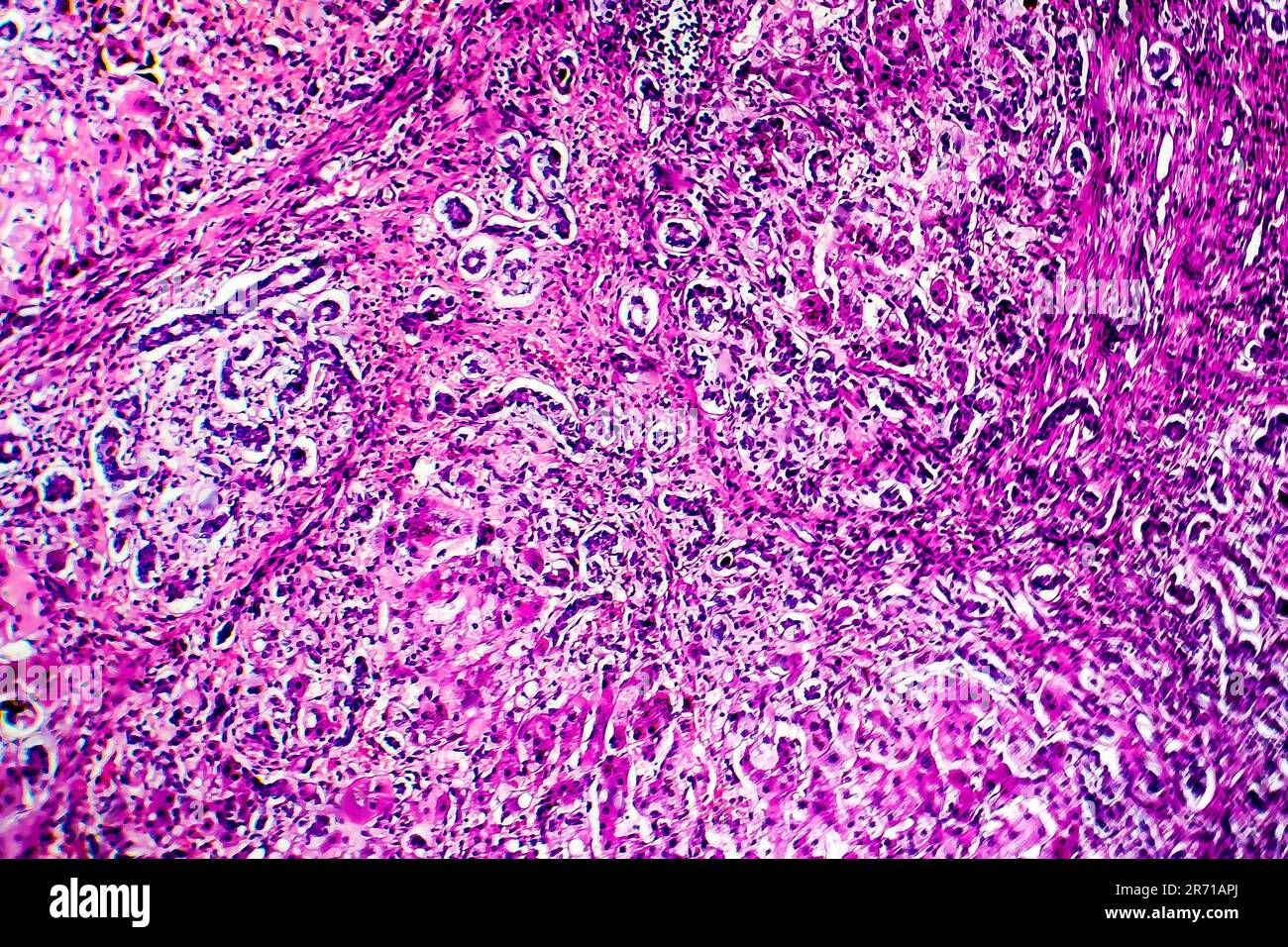 Histopathology of biliary liver cirrhosis, light micrograph, photo ...