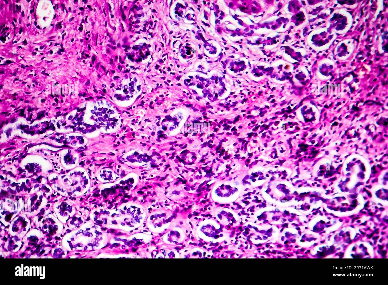 Histopathology of biliary liver cirrhosis, light micrograph, photo ...